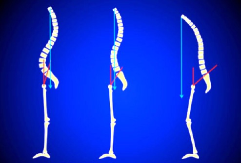 Sagittale balans veranderingen - Spine Center Amsterdam